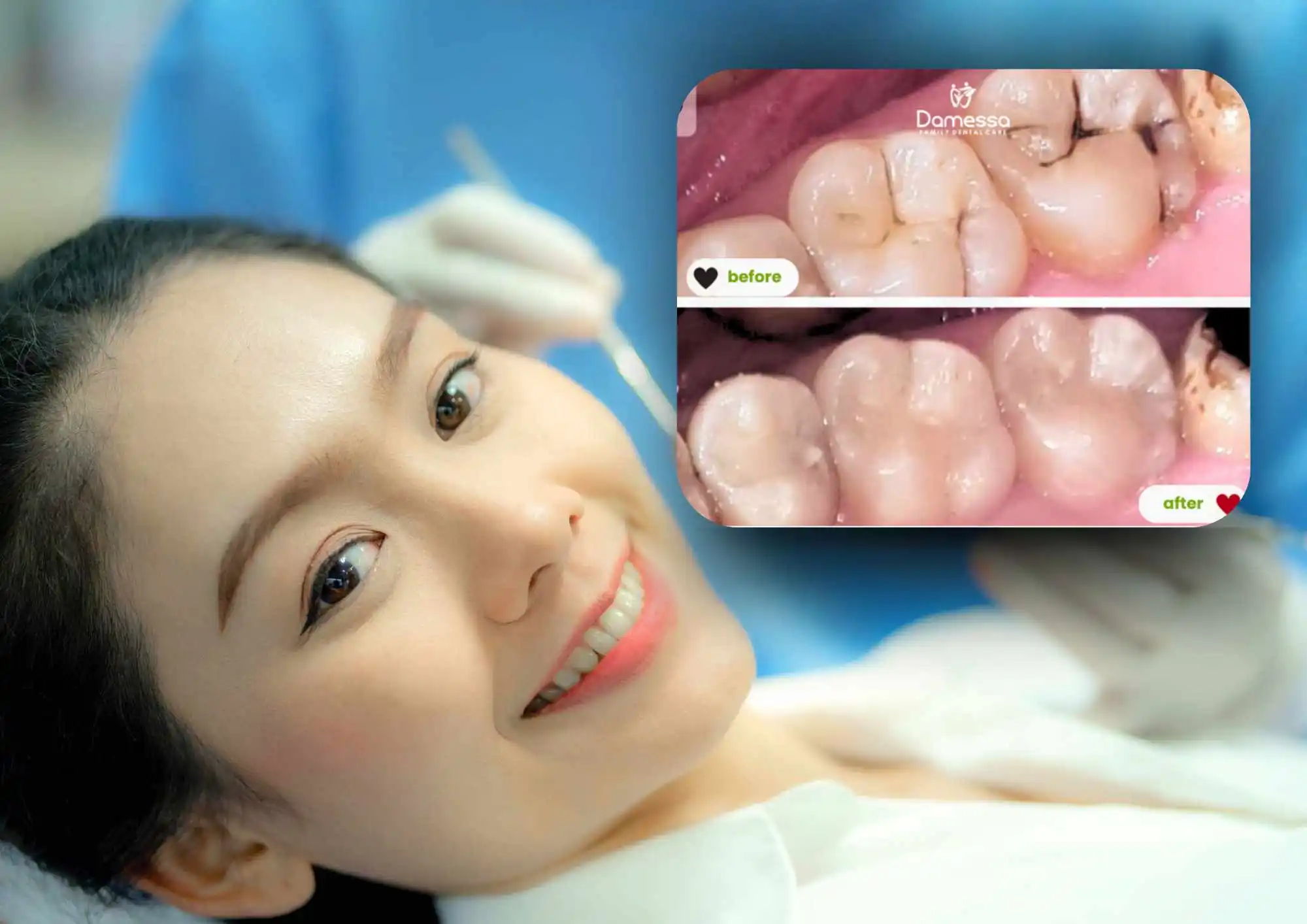 Tips Memilih Tempat Tambal Gigi Alam Sutera yang tidak Abal-abal