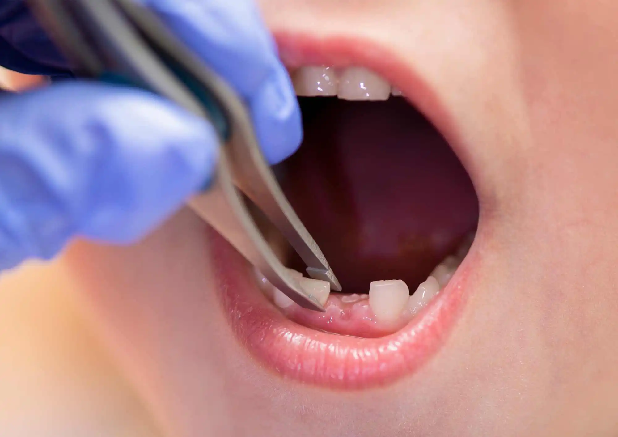 Kenapa Gigi Tanggal Harus Segera Diganti?