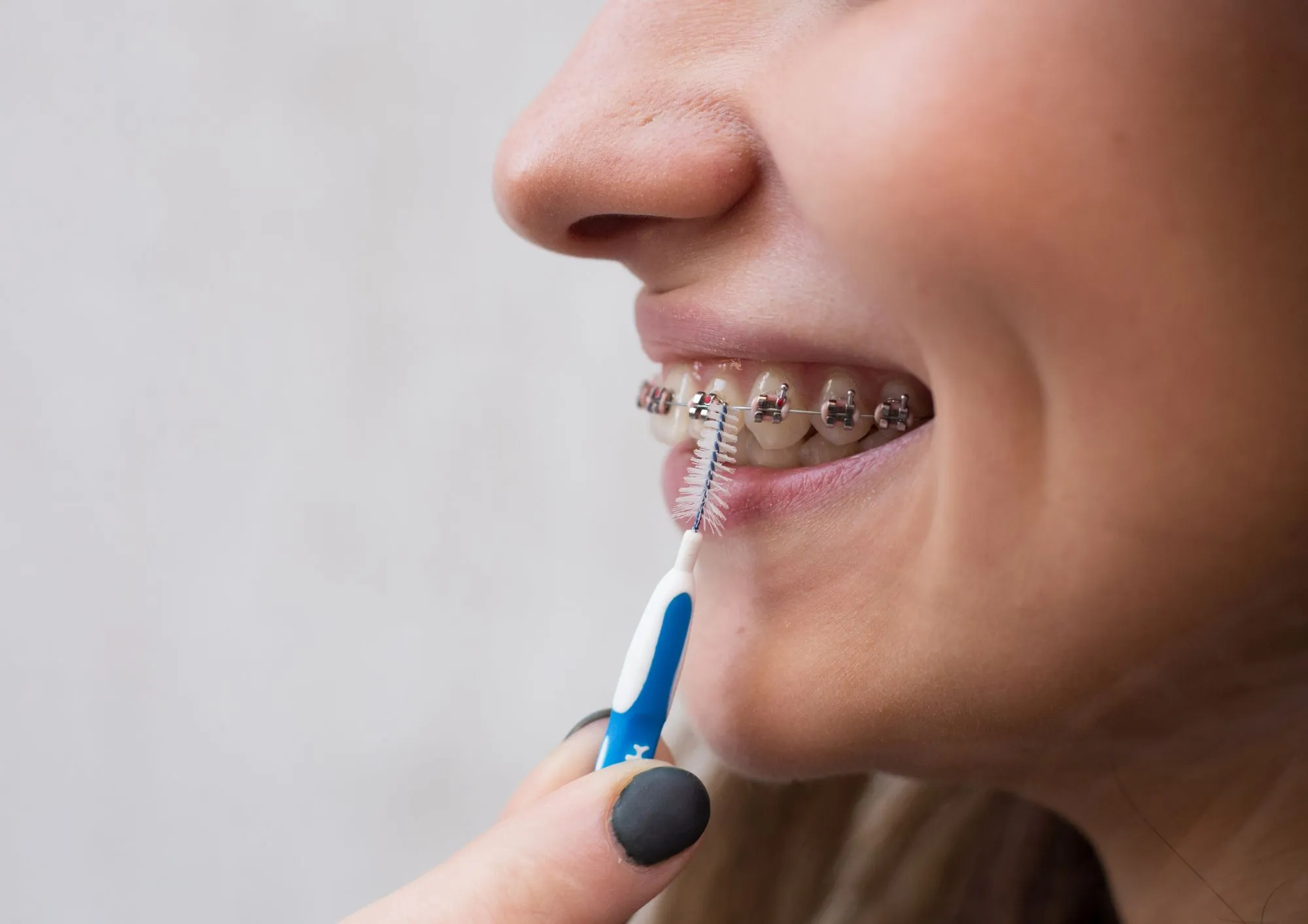 Perlukah Sikat Gigi Khusus Behel bagi Pengguna Ortho?