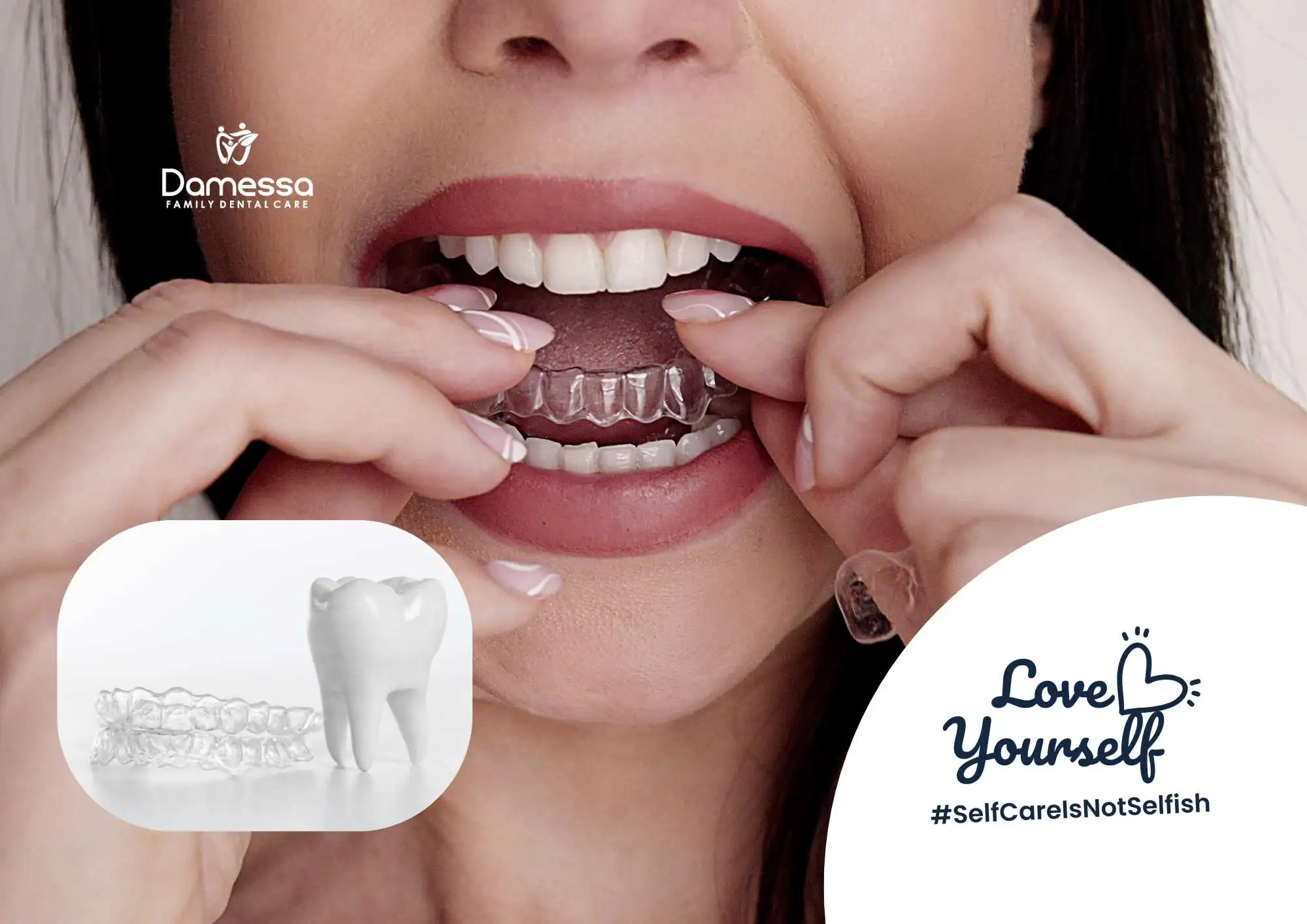 Perlu Pasang Aligner? Cek Dulu Harga Clear Aligner Di Dokter Gigi ...