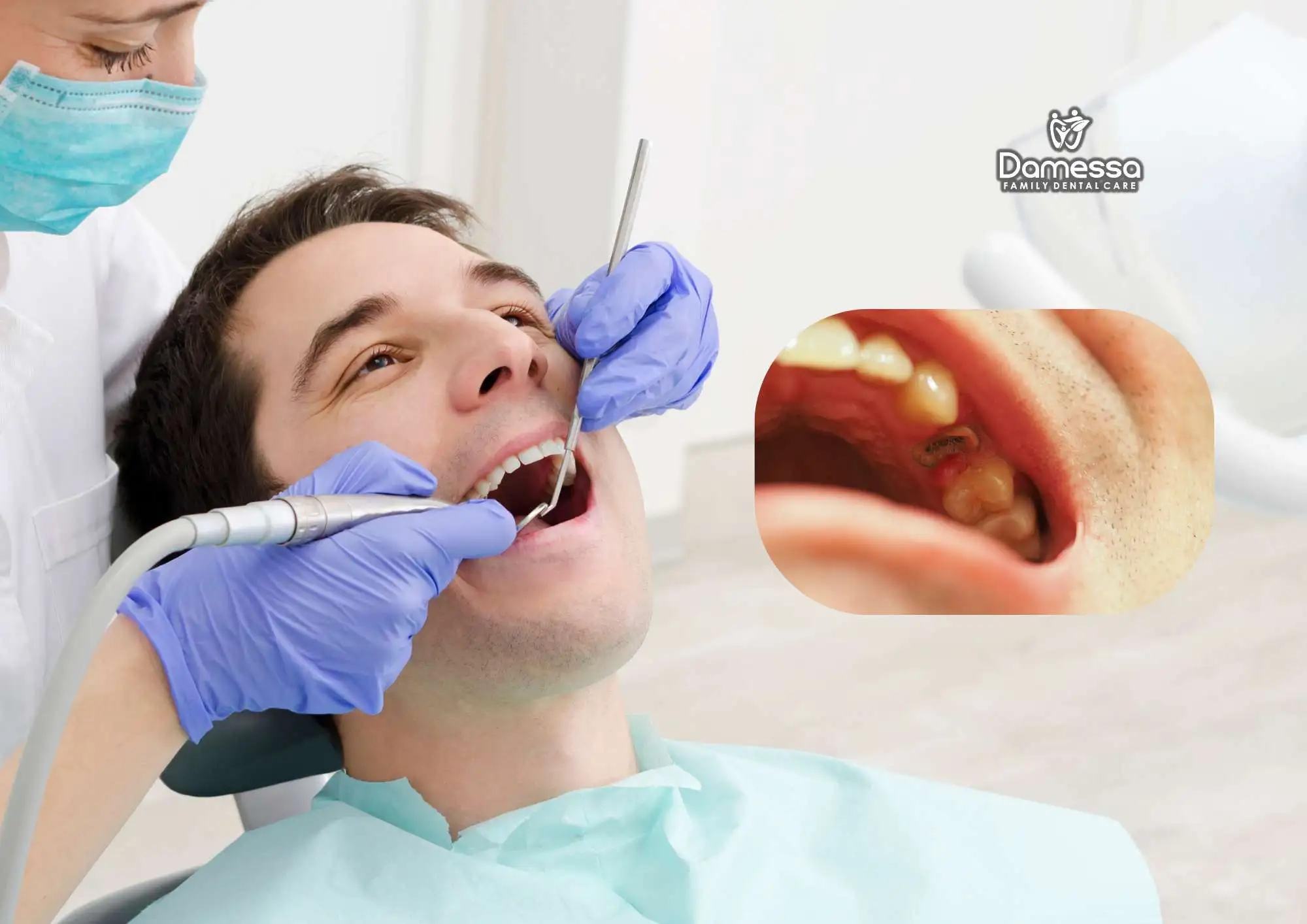 Ketahui Biaya Cabut Sisa Akar Gigi di Klinik Gigi Jakarta