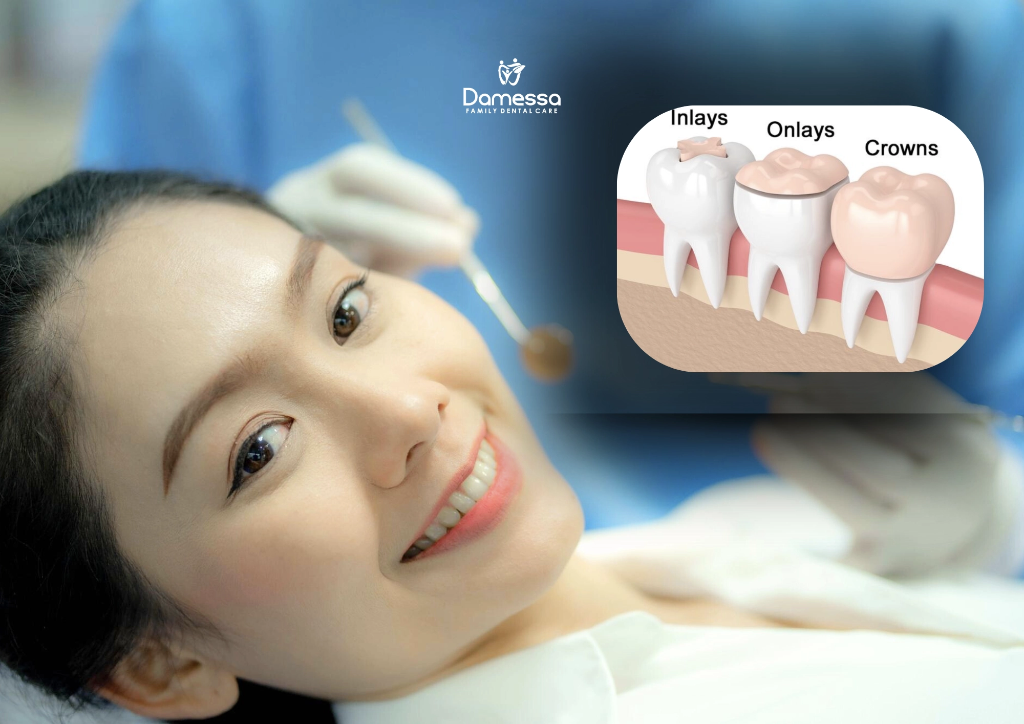 Mengenal Inlay dan Onlay Gigi, Prosedur Tambal Gigi Unik