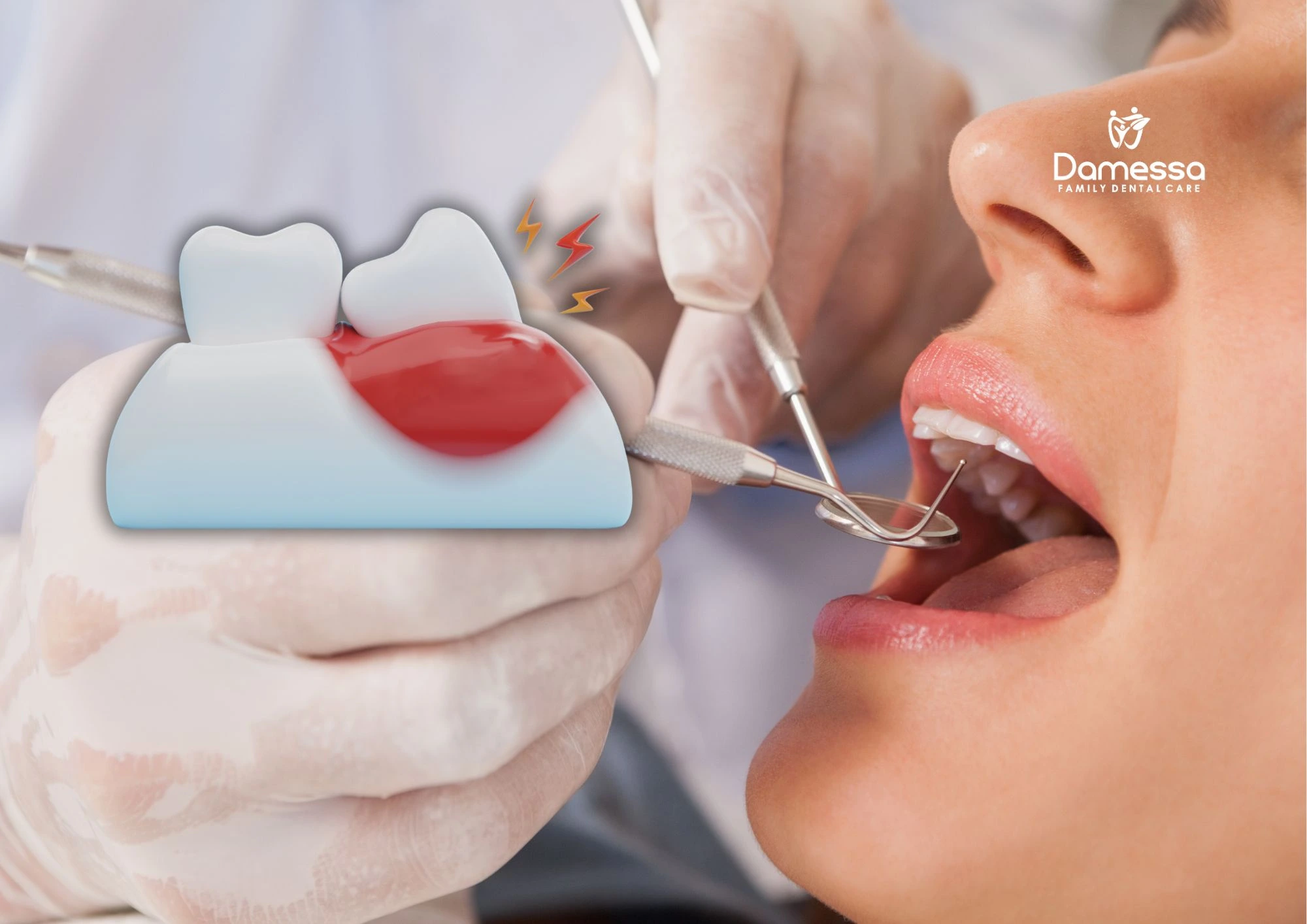 7 Penyebab Sariawan di Gusi dan Cara Mengatasinya